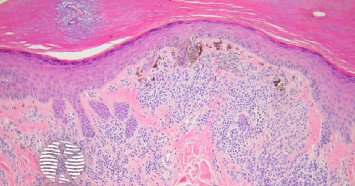 Melanocytic naevus pathology: acral naevus image
