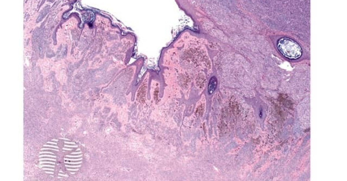 Congenital naevus pathology image