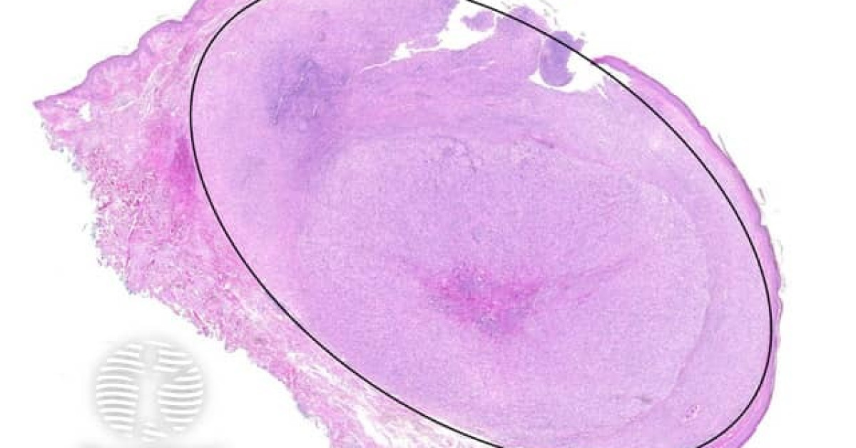 Congenital naevus pathology image