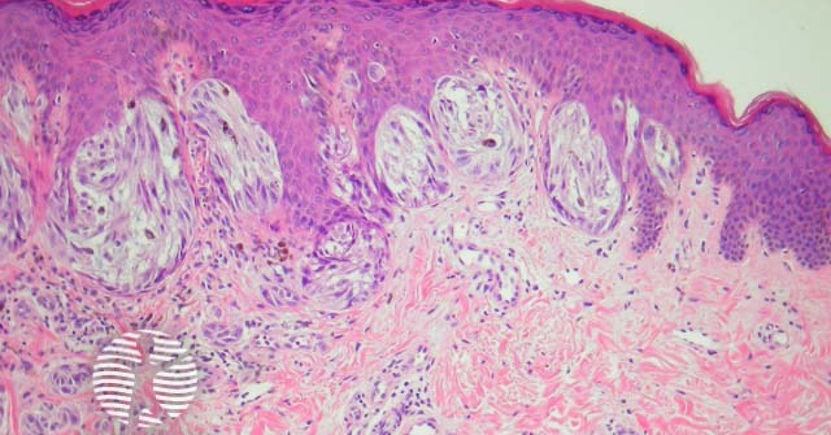 Spitz naevus pathology image