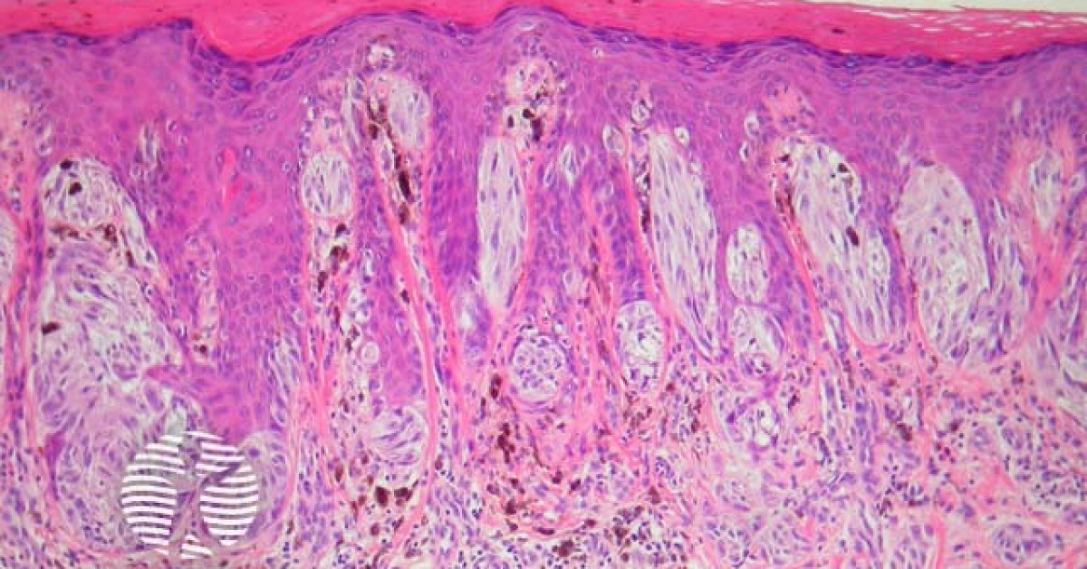 Spitz naevus pathology image