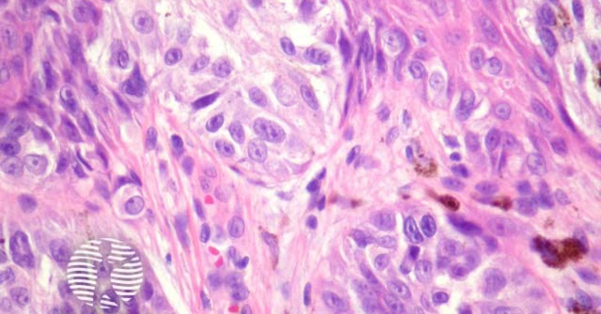Spitz naevus pathology image