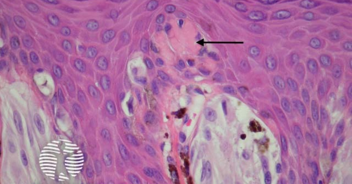 Spitz naevus pathology image