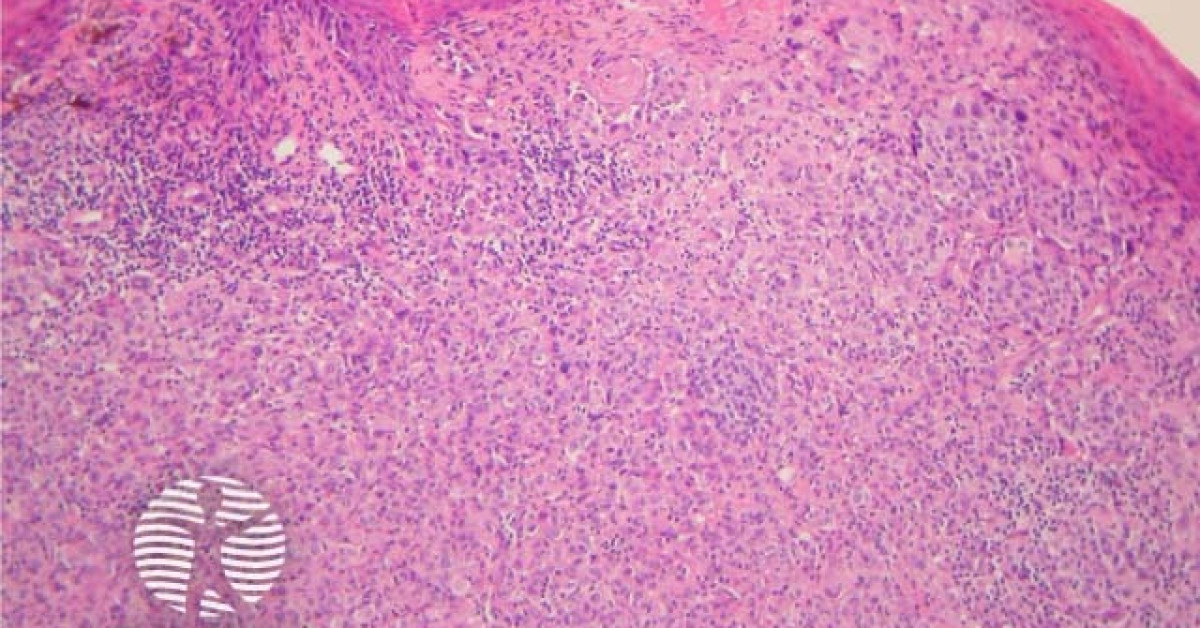 Malignant Spitz tumour pathology image