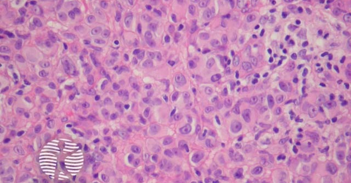 Malignant Spitz tumour pathology image