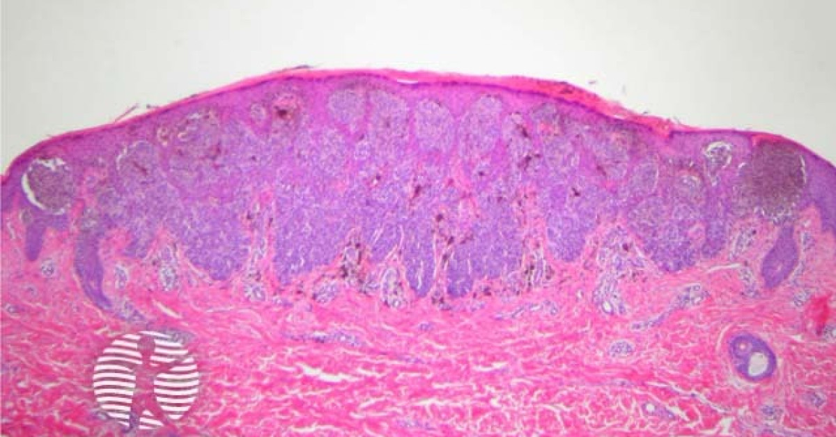 Pigmented spindle cell naevus of Reed pathology image