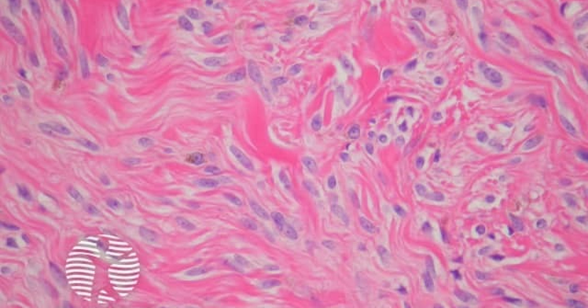 Common blue naevus pathology image