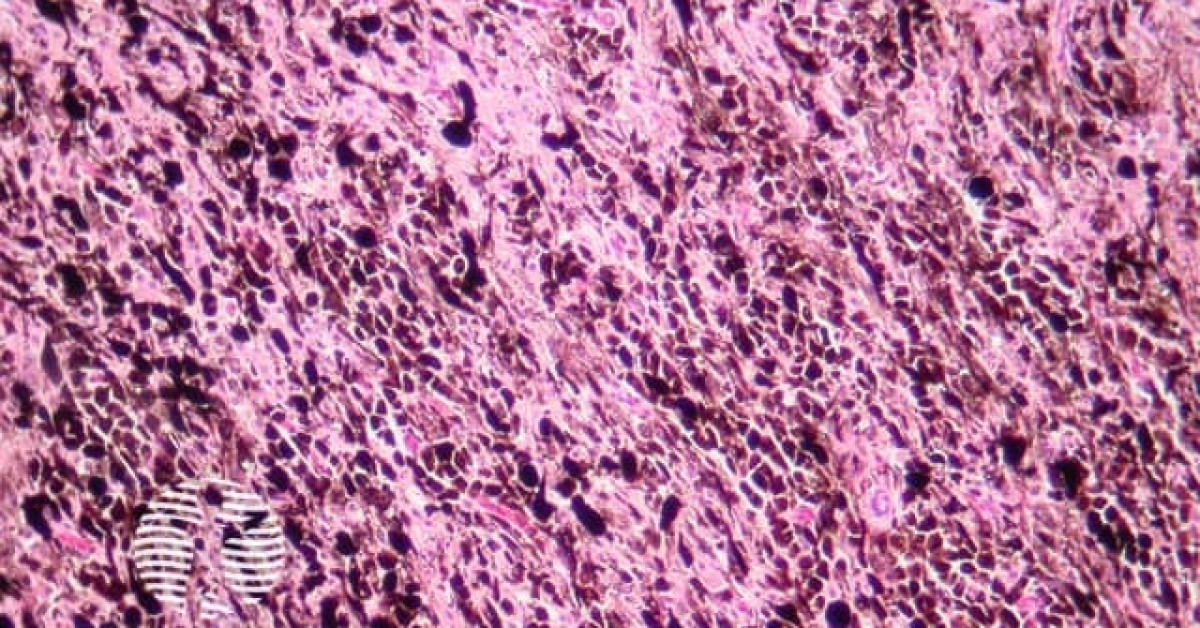 Epithelioid blue naevus pathology image