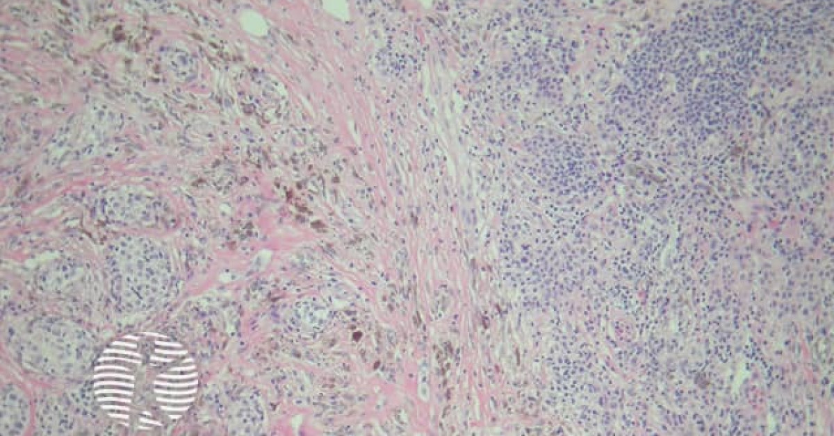DermNet® - Combined naevus pathology image