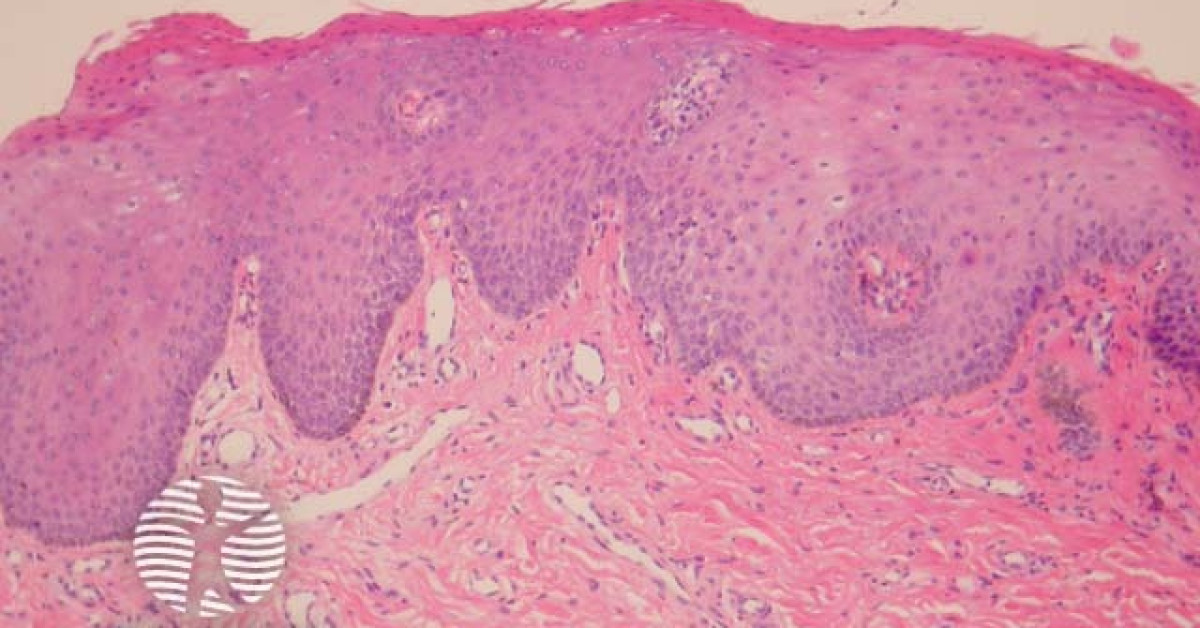 Labial melanotic macule pathology image