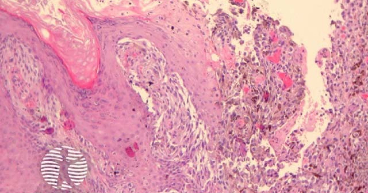 Melanoma pathology: ulceration image