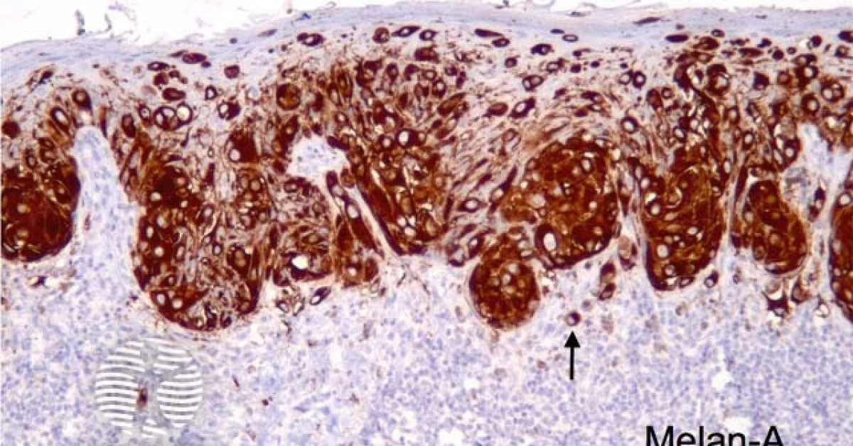 Melanoma in situ - Melan-A staining image