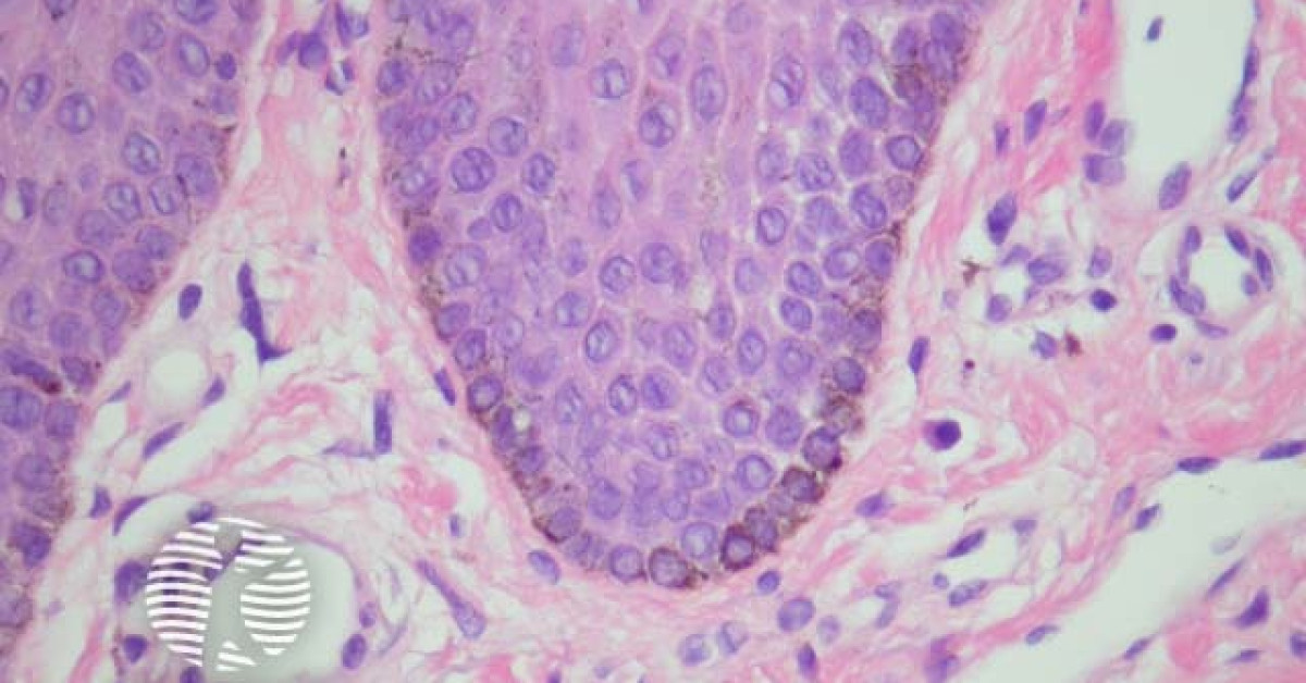 Labial melanotic macule pathology image