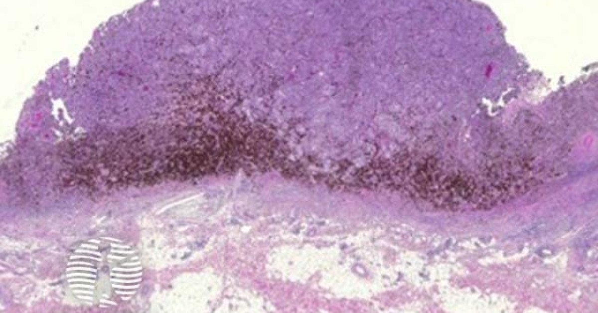 Melanoma pathology: lentigo maligna melanoma image
