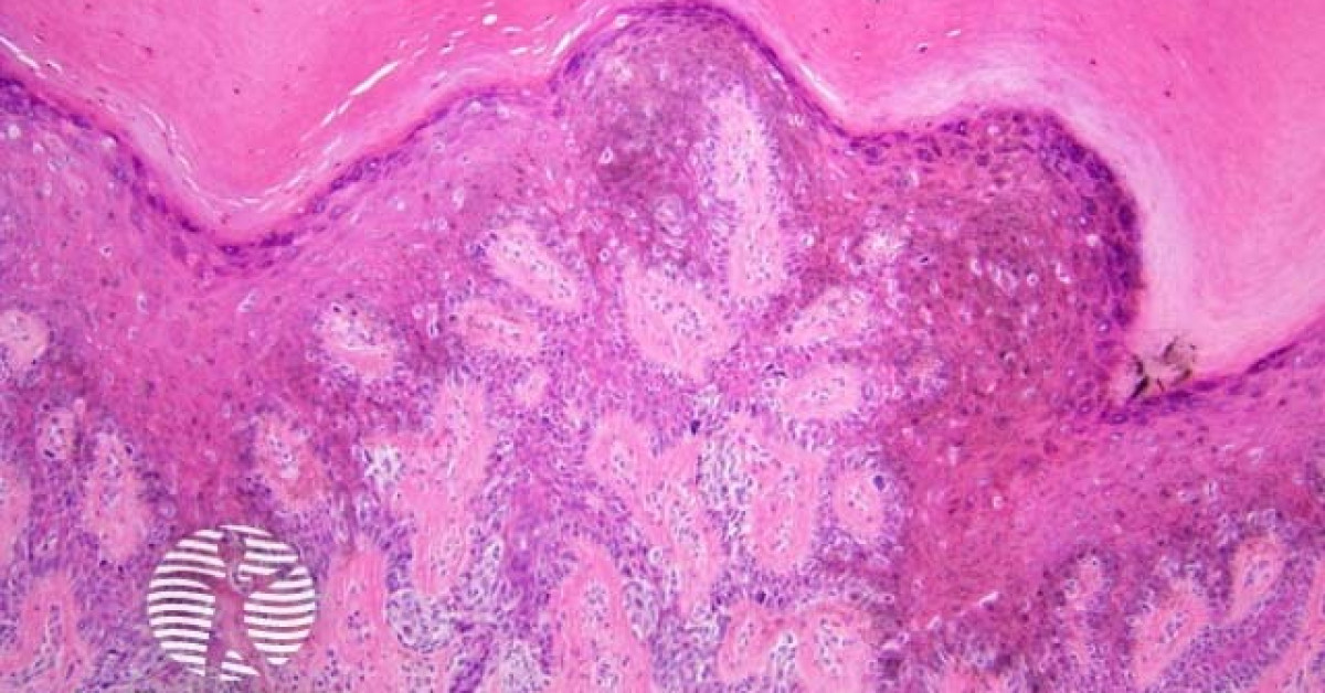Melanoma pathology: Acral lentiginous melanoma image