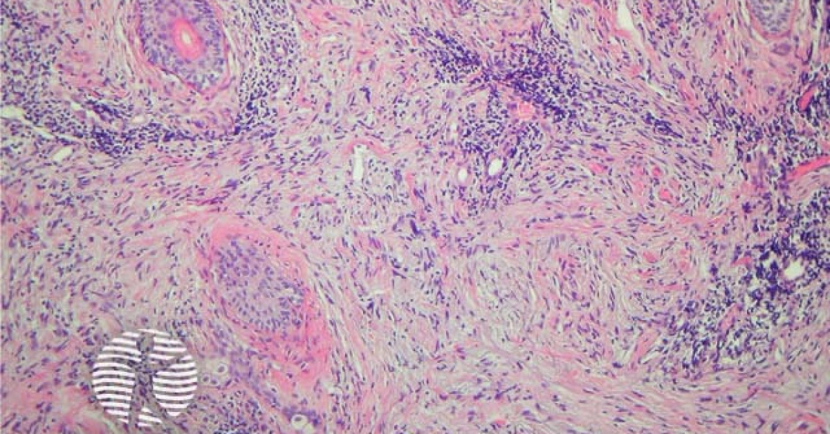 Melanoma Pathology Tumour Infiltrating Lymphocytes Image