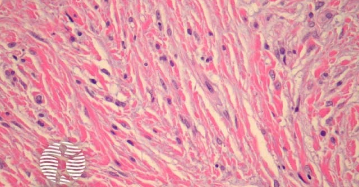 Melanoma Pathology Tumour Infiltrating Lymphocytes Image
