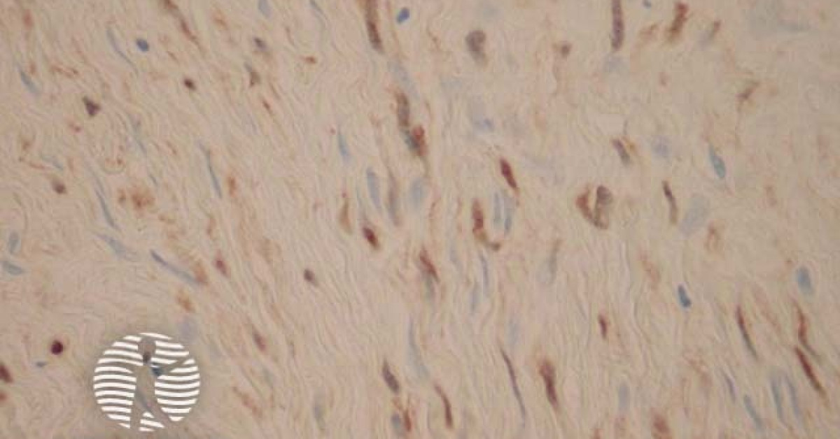 DermNet® - Melanoma pathology: tumour infiltrating lymphocytes image