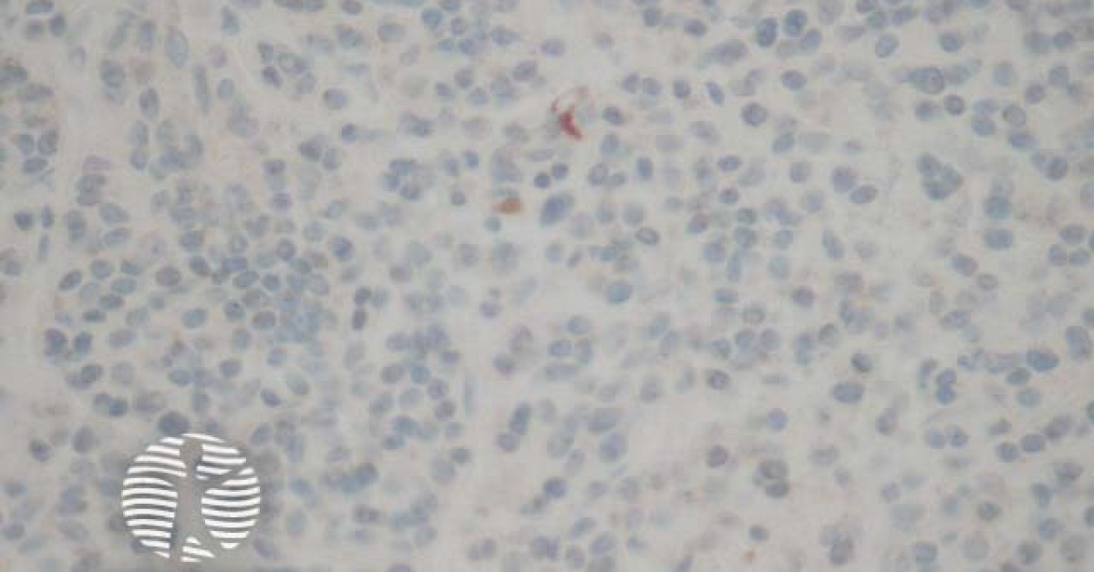 Melanoma pathology: negative BAP-1 staining image