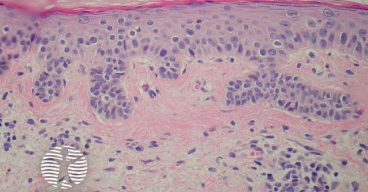 Solar lentigo pathology image