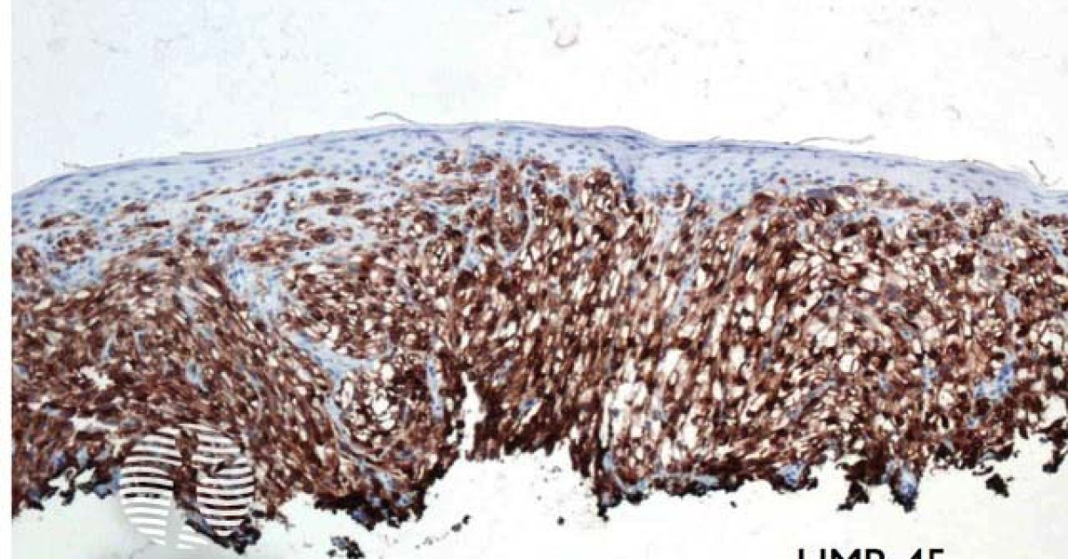 Melanocytic immunostain – HMB-45 image