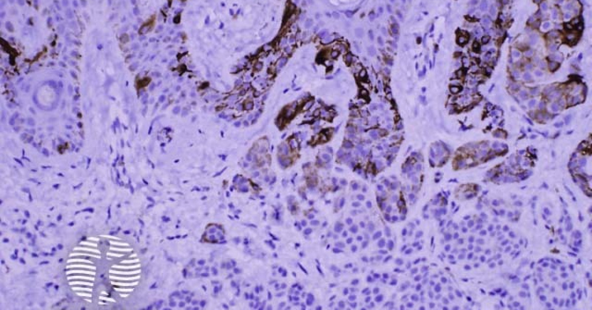 DermNet® - Melanocytic immunostain – HMB-45 image