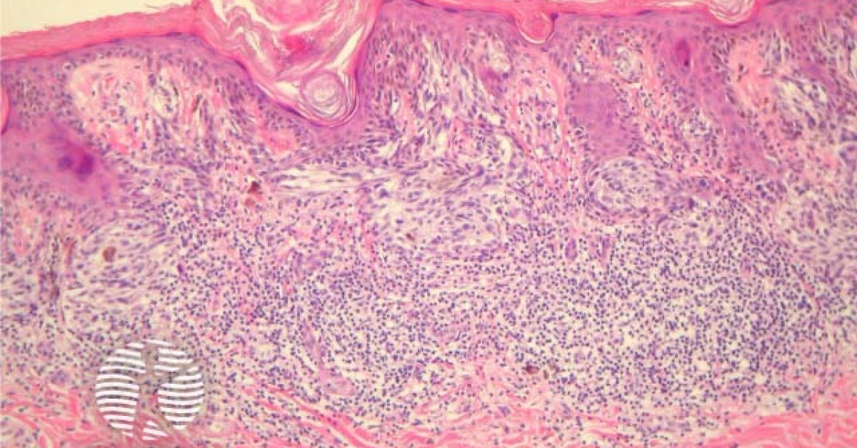 Melanoma pathology: radial growth phase image