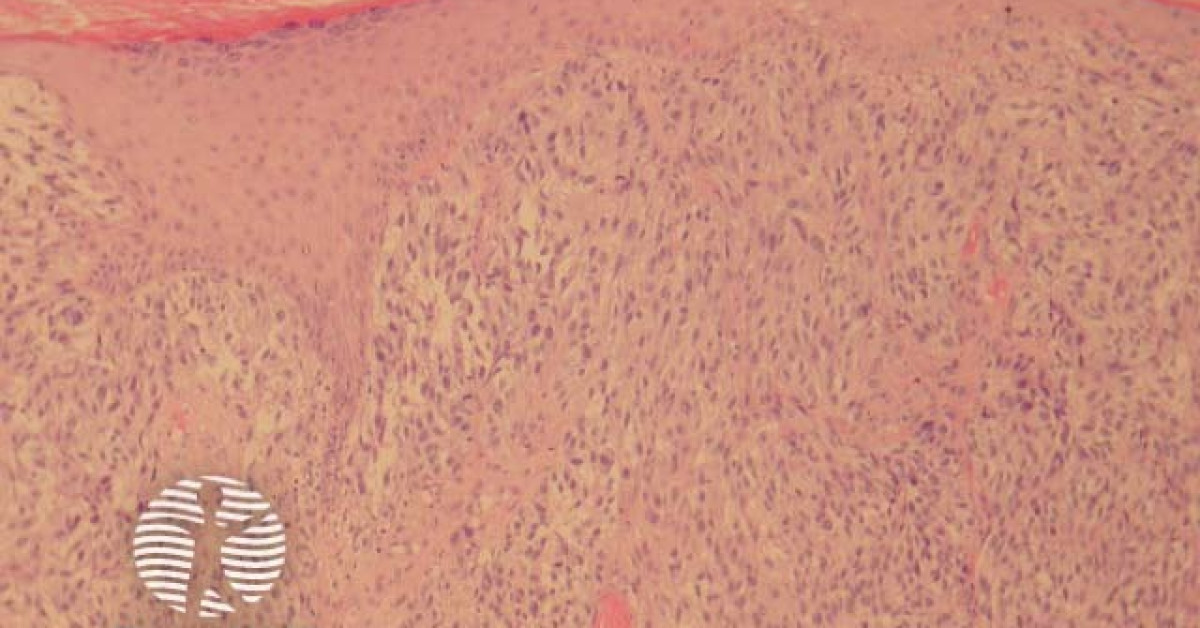 Melanoma pathology: superficial spreading melanoma image