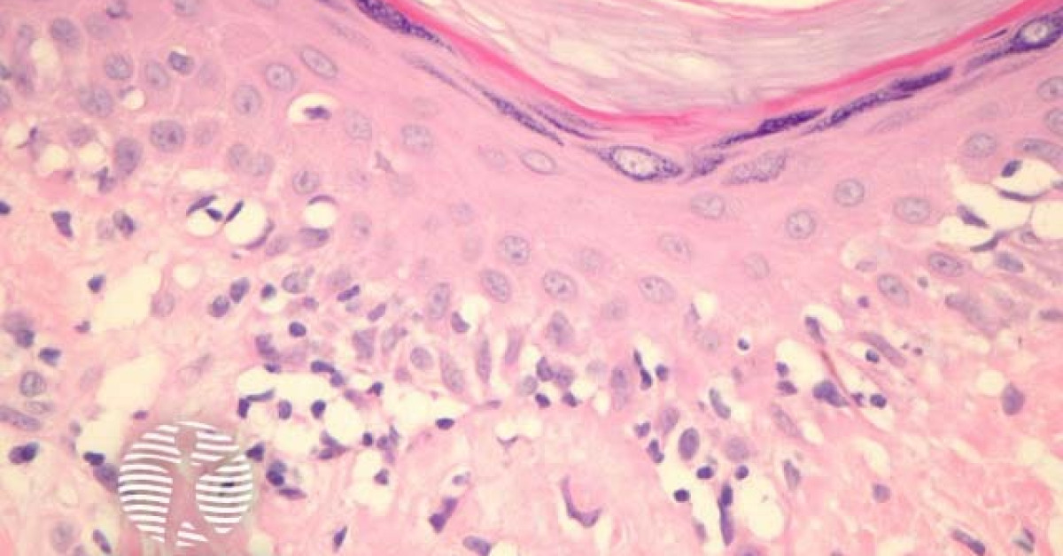 Melanoma pathology: lentiginous melanoma image