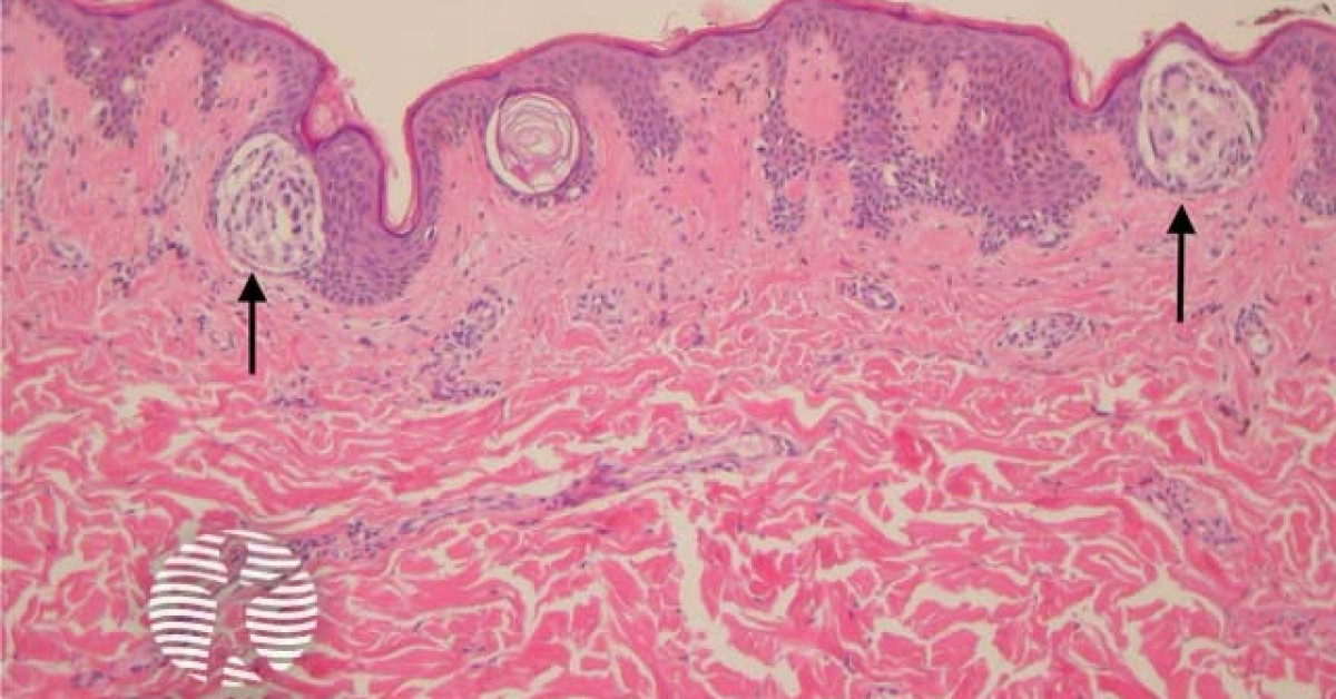 Melanocytic naevus pathology: junctional naevus image