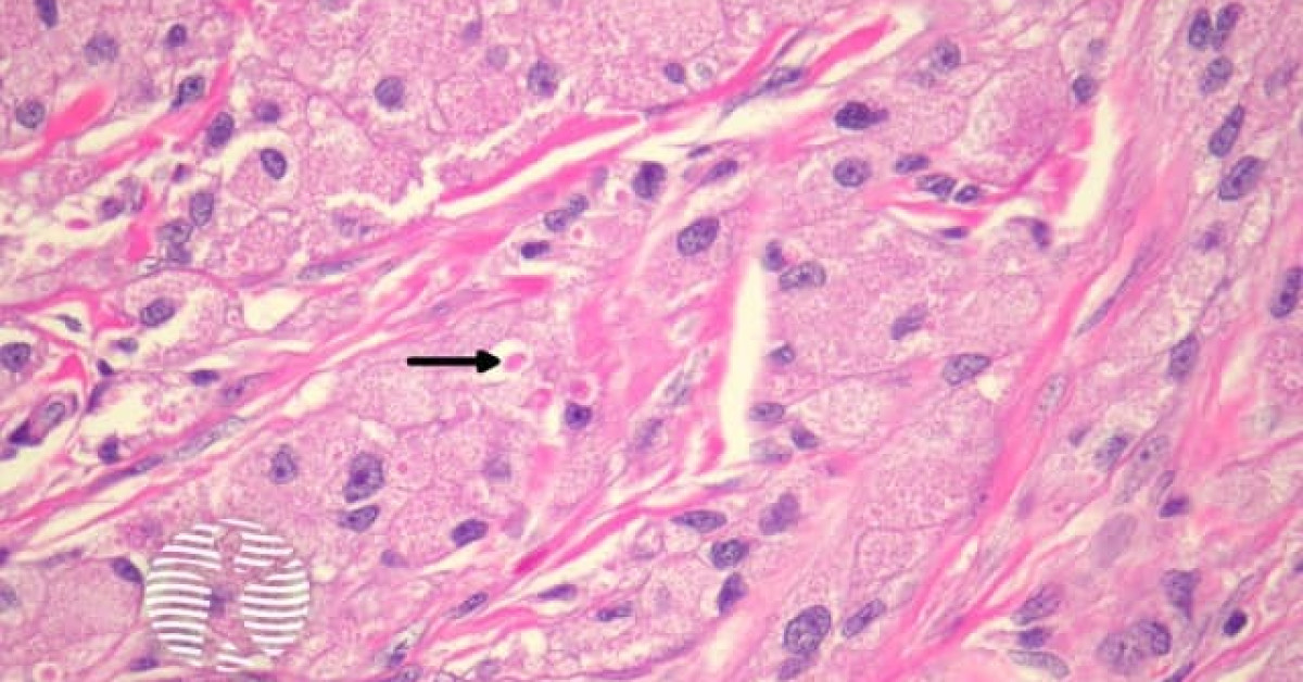Granular cell tumour pathology image