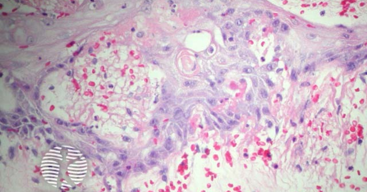 Hand, foot and mouth disease pathology image