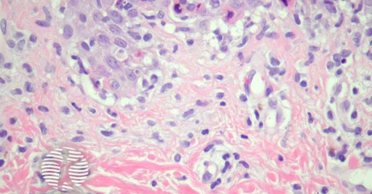 Hand, foot and mouth disease pathology image