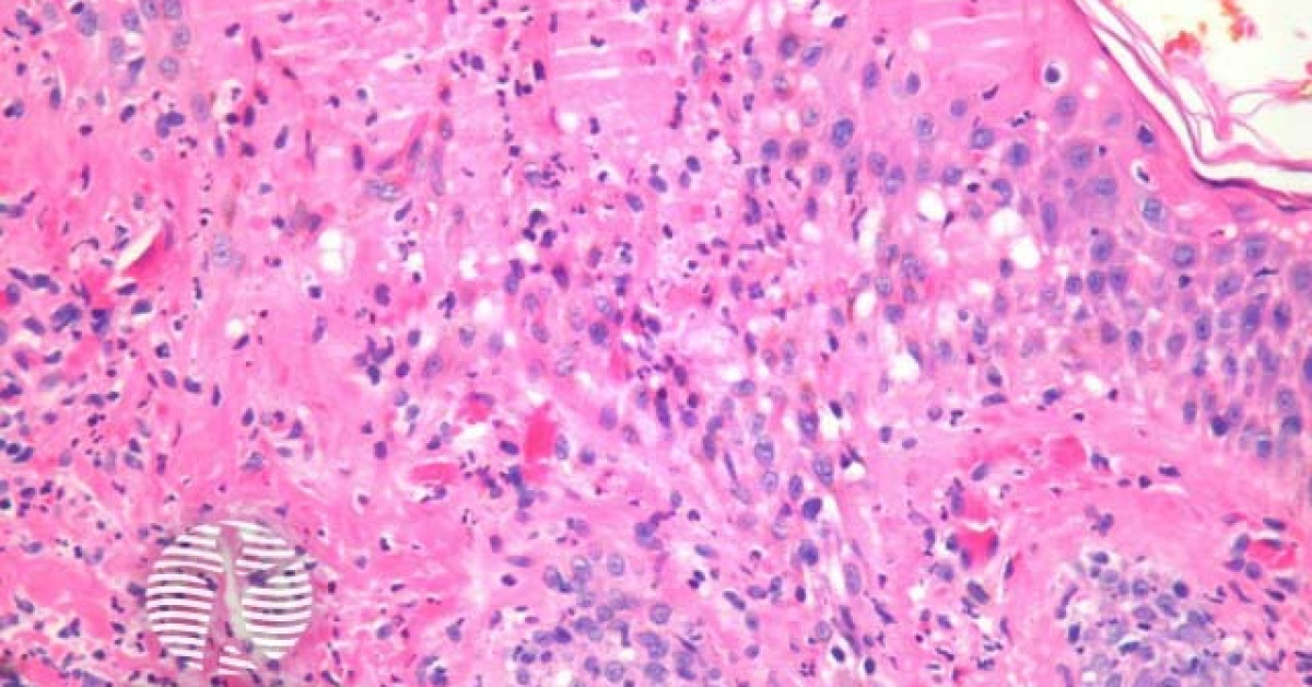 Hydroa vacciniforme pathology image
