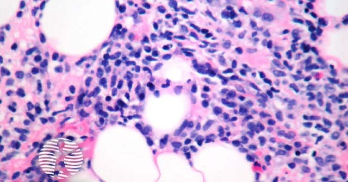 Hydroa vacciniforme pathology image