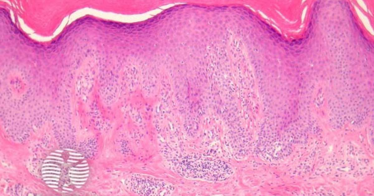 Inflammatory Linear Verrucous Epidermal Naevus pathology image
