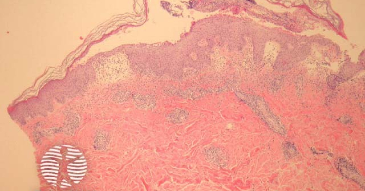 Impetigo pathology image