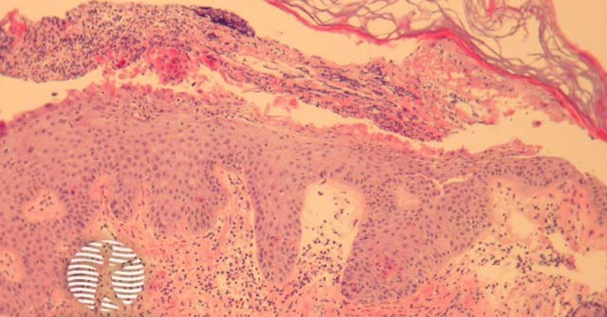 Impetigo pathology image