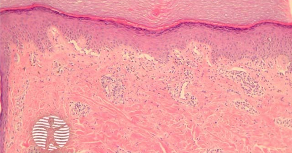 Lichen striatus pathology image