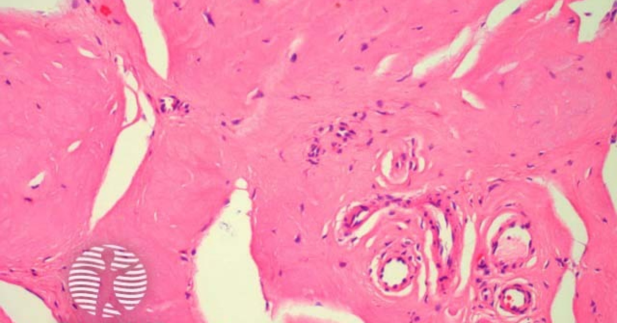 Lipoid proteinosis pathology image
