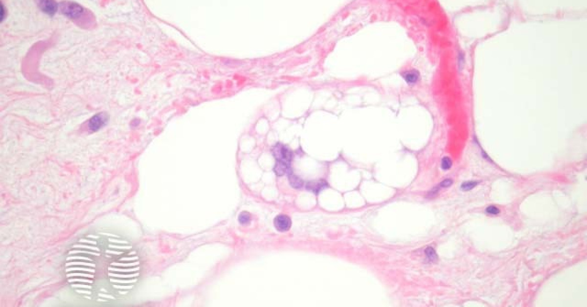 Liposarcoma pathology image