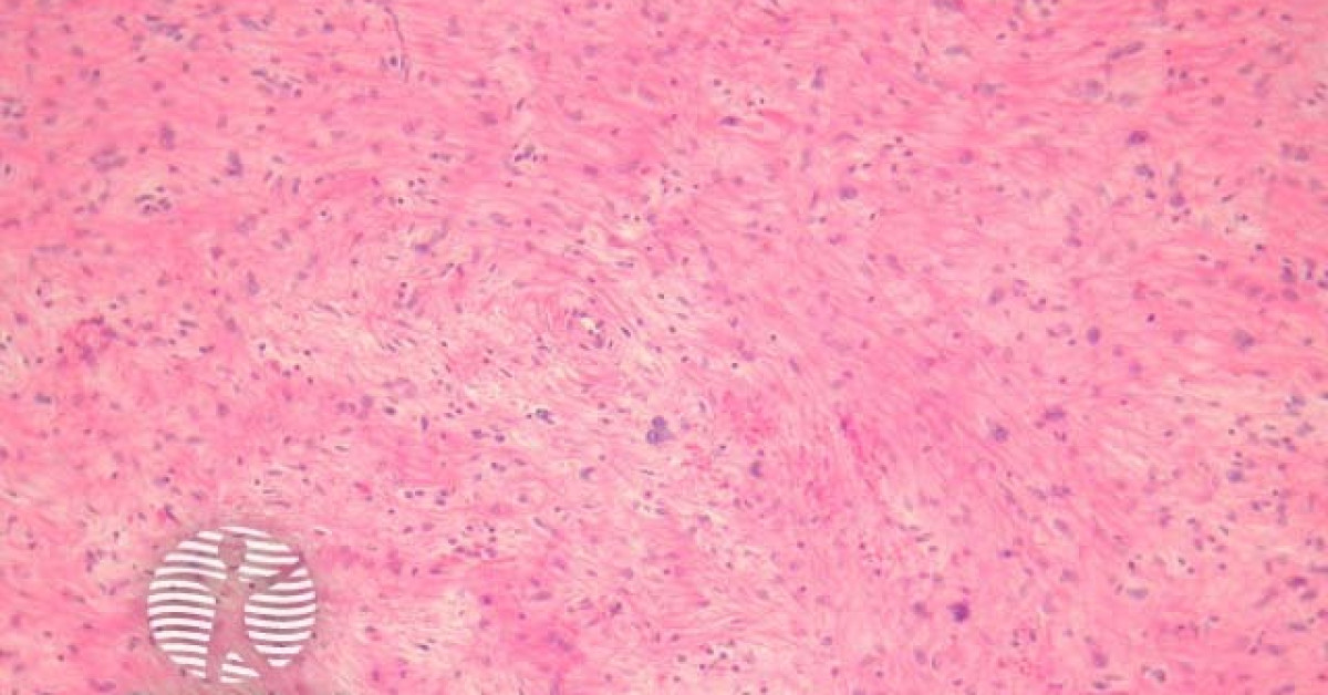 Sclerosing variant of well-differentiated liposarcoma pathology image