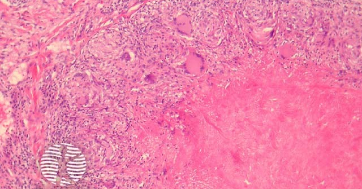 Lupus miliaris disseminatus faciei pathology image