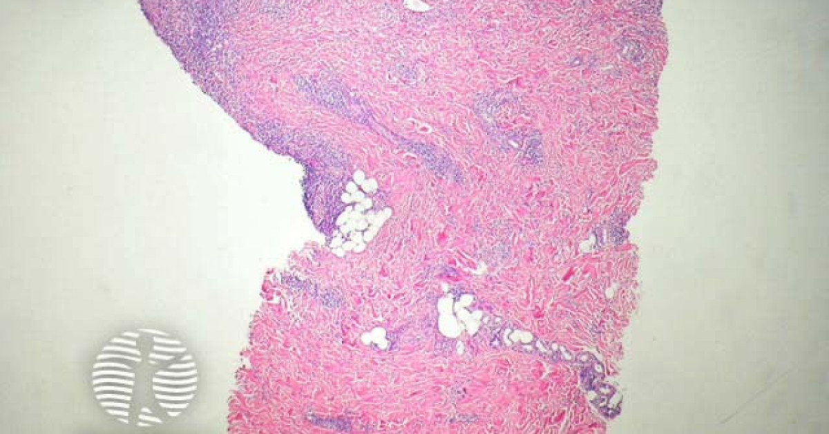 Lyme disease pathology image
