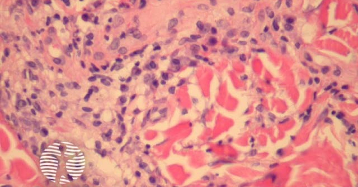 Lyme disease pathology image