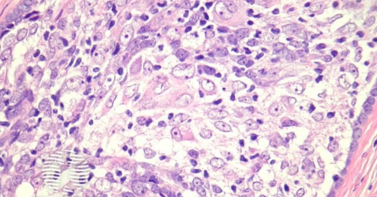 Pathology of cutaneous lymphadenoma image