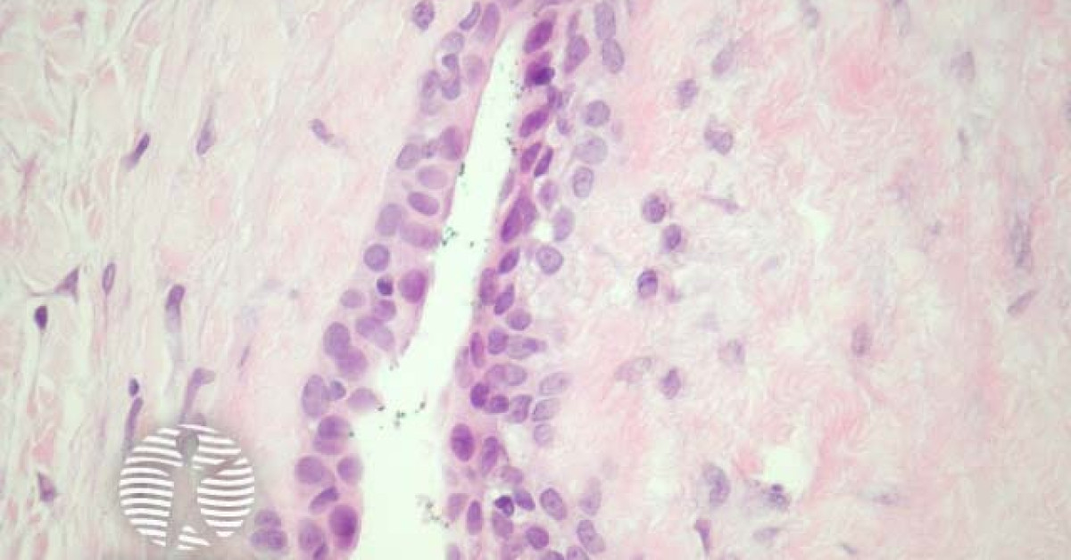 Median raphe cyst pathology image