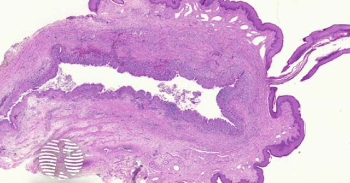 Median raphe cyst pathology image