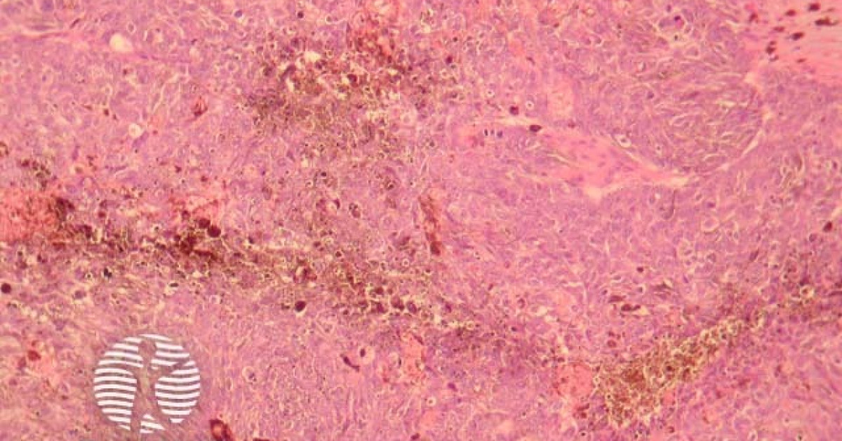 Melanocytic matricoma pathology image