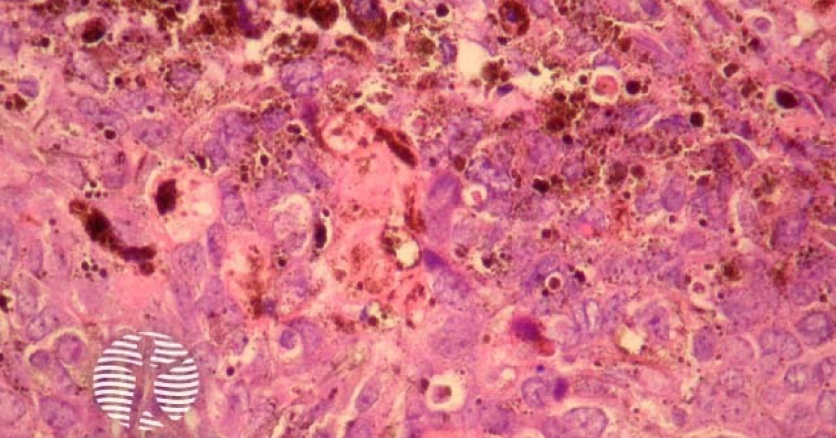 Melanocytic matricoma pathology image